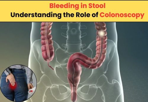 Understanding the Difference between Endoscopy and Colonoscopy ...