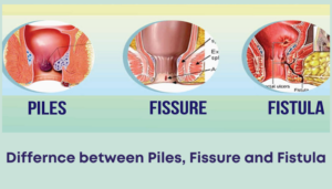 Understanding Fissures vs. Fistulas: Causes, Symptoms, and Advanced Treatment